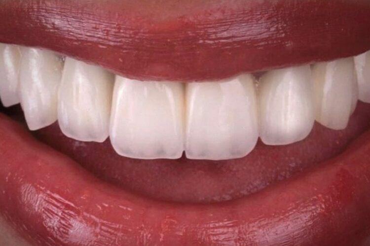 Fixed bridge prosthesis