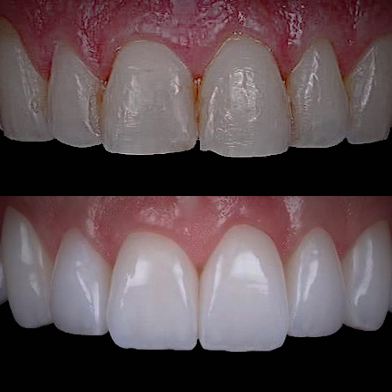 Prosthetic dentistry, types of prosthetics - Orthopedic dentistry in Kiev