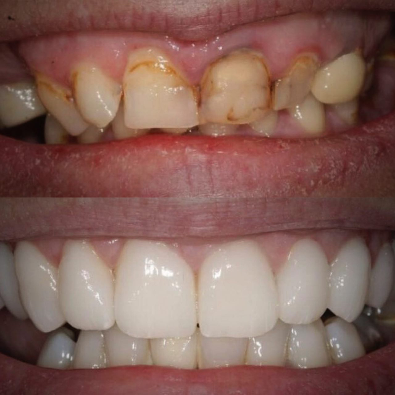 Ceramic dental crowns on the frame of zirconium dioxide - Installation ...