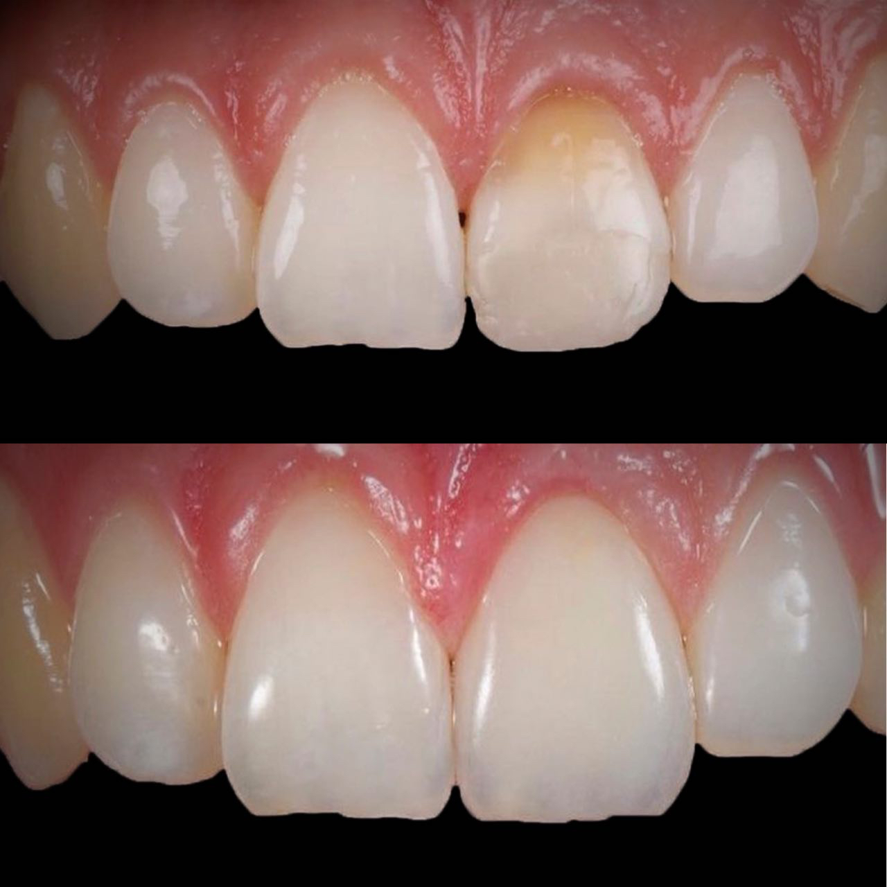 Prosthetic dentistry, types of prosthetics - Orthopedic dentistry in Kiev