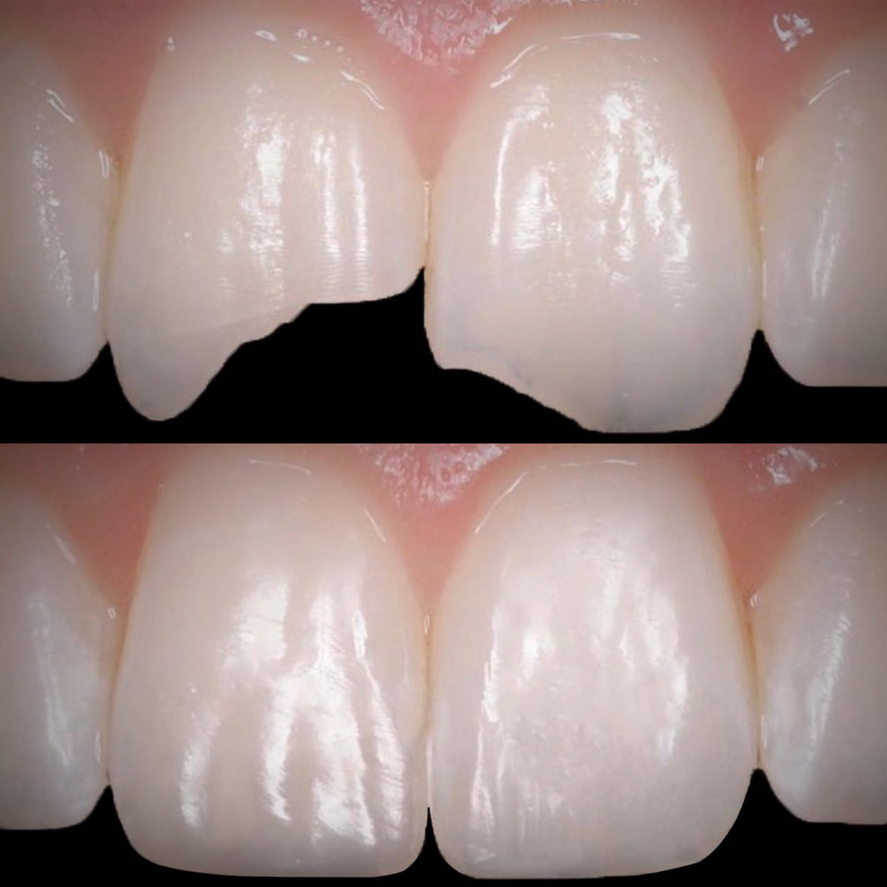 Art restoration of teeth 🦷 Prices | iStomatolog dentistry, Kyiv