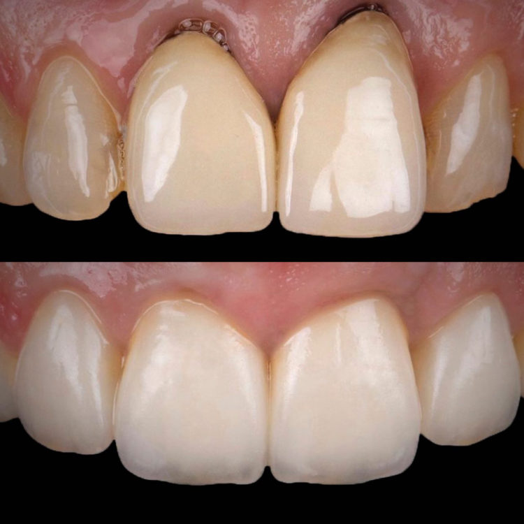 Metal-free crowns🦷 Ceramic and zirconia | iStomatolog, Kyiv